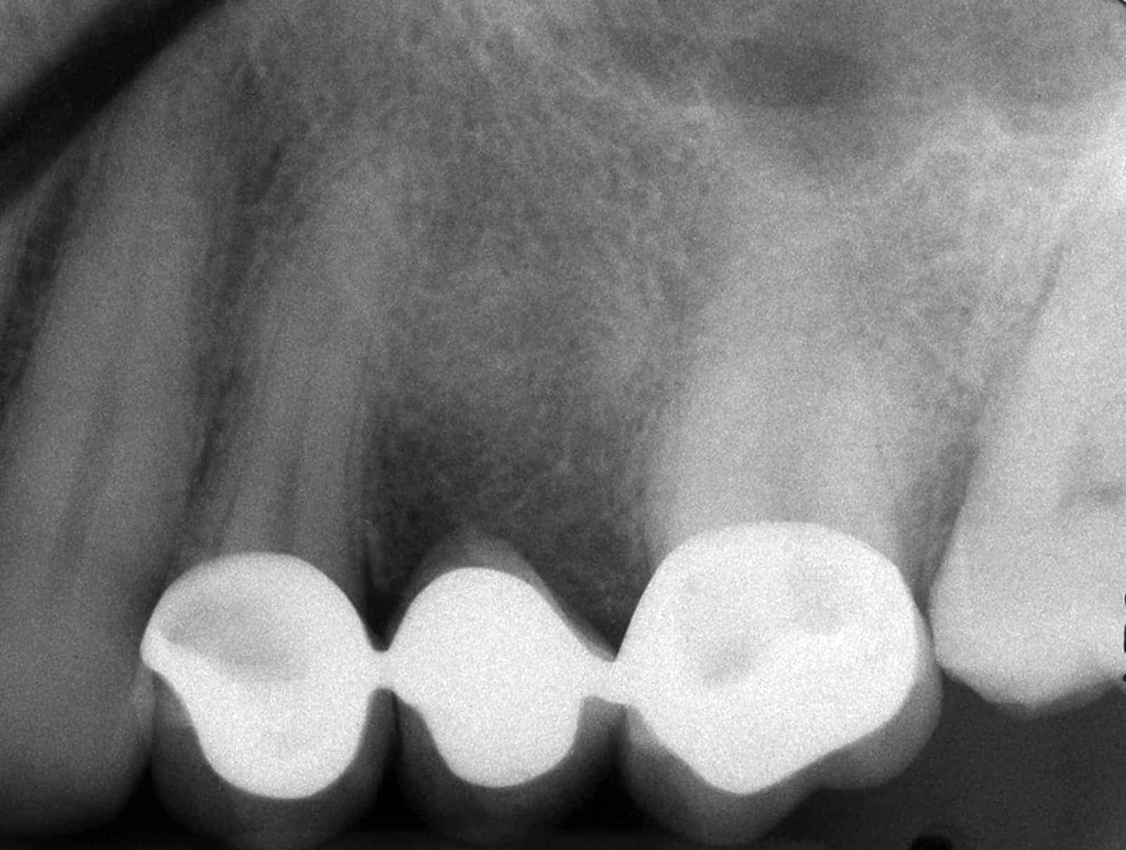 Case Study - Dental Bridge