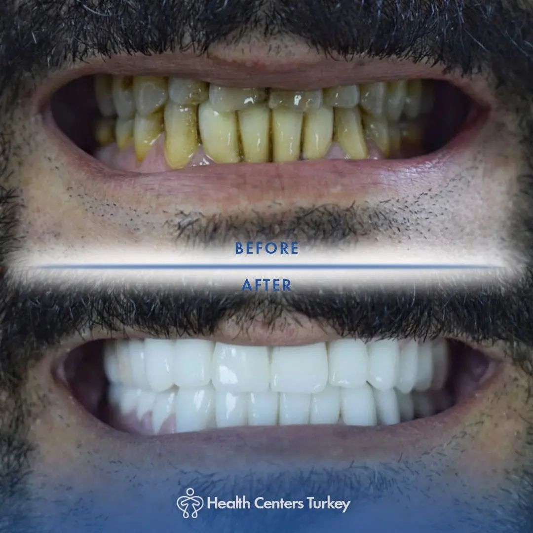 How Much Do Veneers Cost in Turkey l Veneers in Turkey l HCT