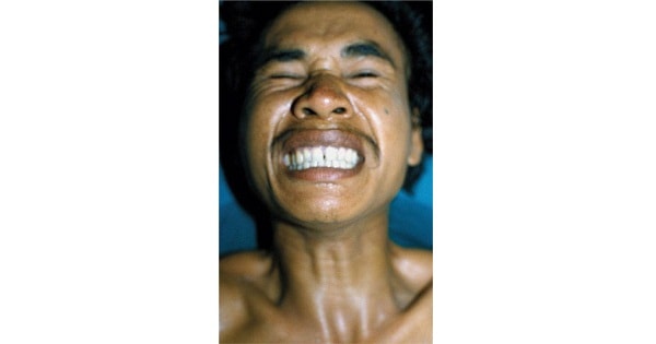 Clostridium tetani: Clinical manifestations - www.medicoapps.org