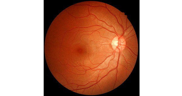 Optic Neuritis - www.medicoapps.org