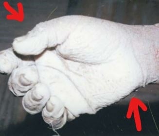 Drowning-Autopsy findings - www.medicoapps.org