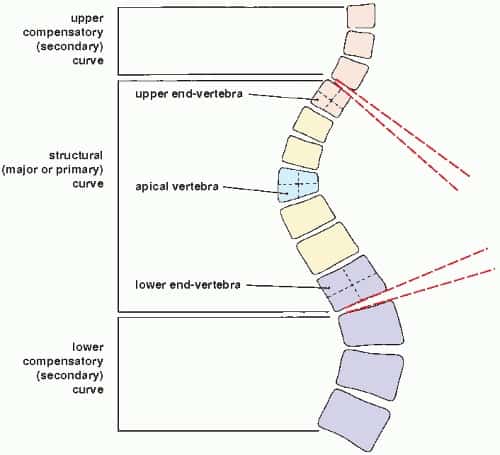 SCOLIOSIS - www.medicoapps.org