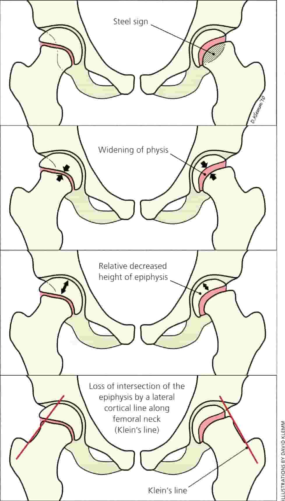 SLIPPED CAPITAL FEMORAL EPIPHYSIS (SCFE) - www.medicoapps.org
