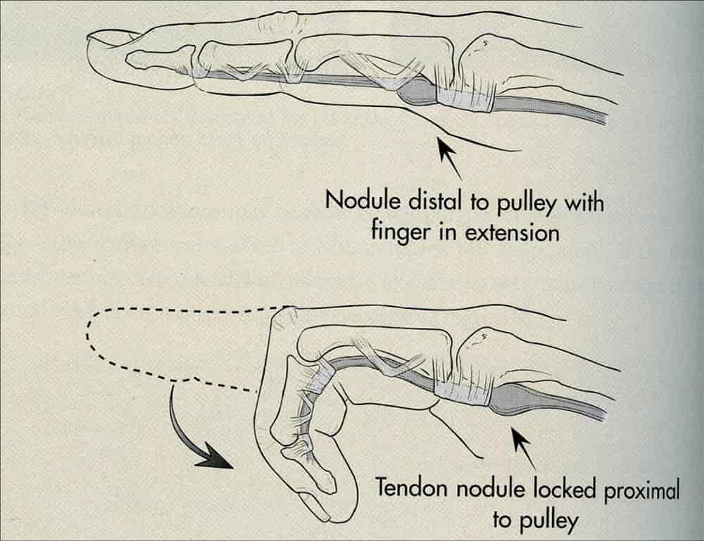 TRIGGER FINGER/ THUMB - www.medicoapps.org