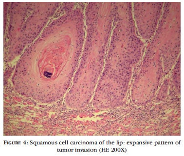 Carcinoma Lip - www.medicoapps.org
