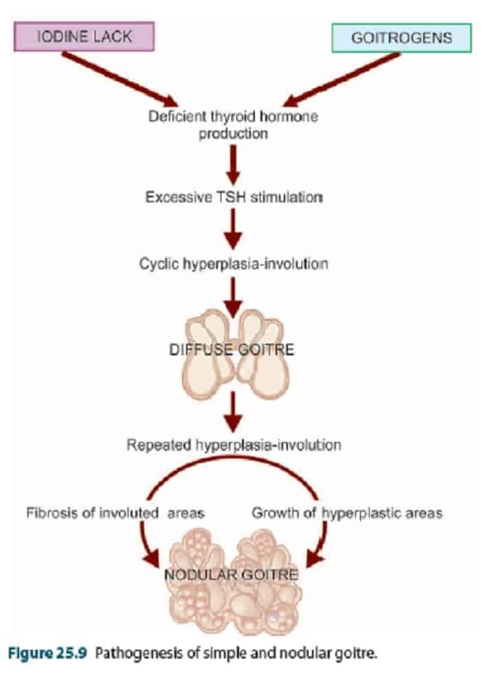 Goitre Classification & Pathology - www.medicoapps.org
