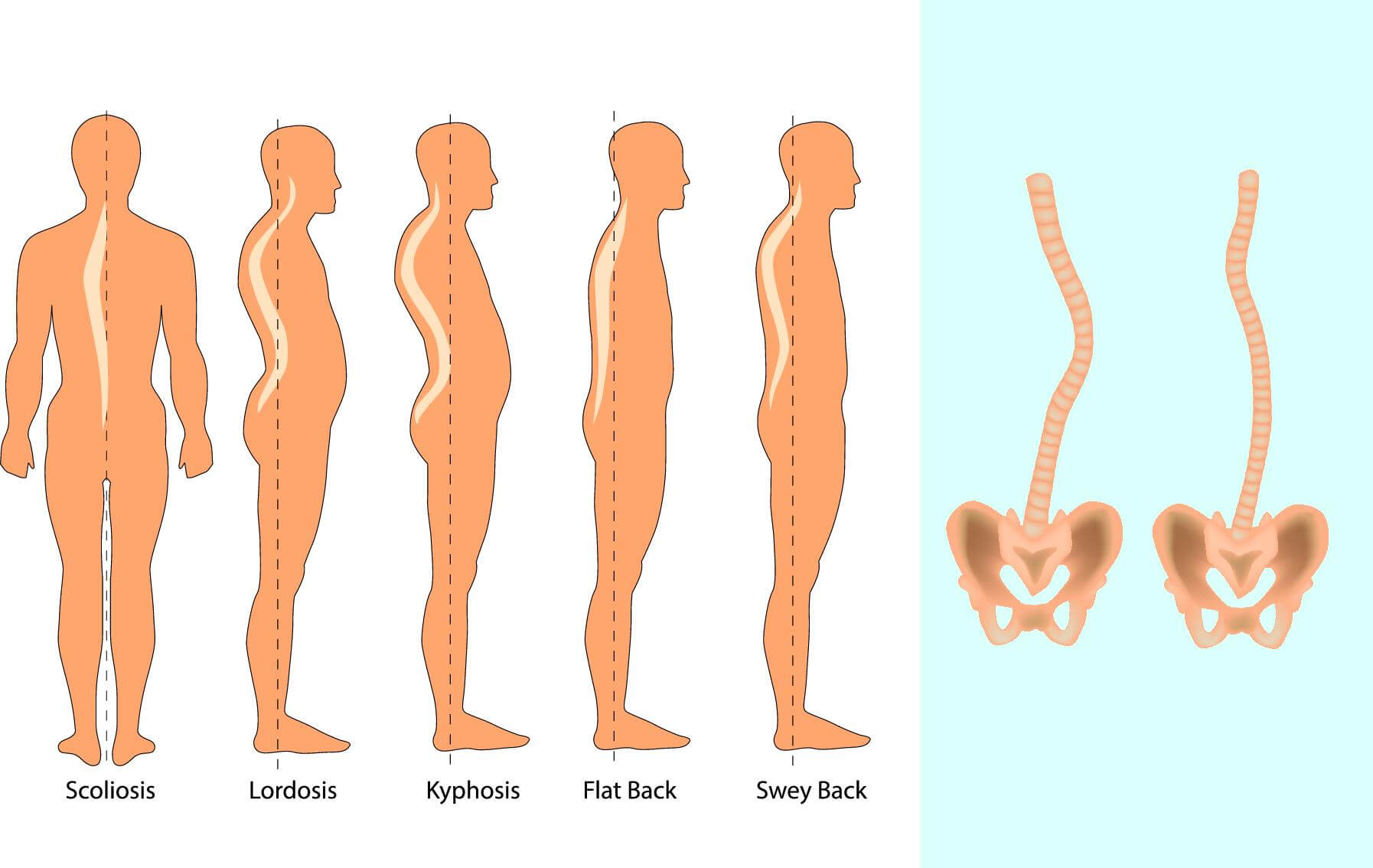 Correcting Poor Posture With Chiropractic | Scofield Chiropractic