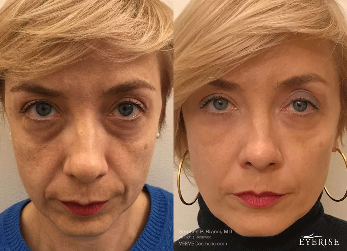 EyeRise | Eye Bag Surgery Alternative | Photos, Pricing