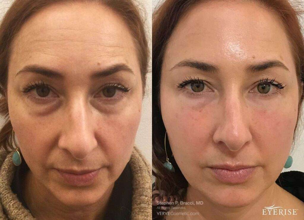 EyeRise | Eye Bag Surgery Alternative | Photos, Pricing