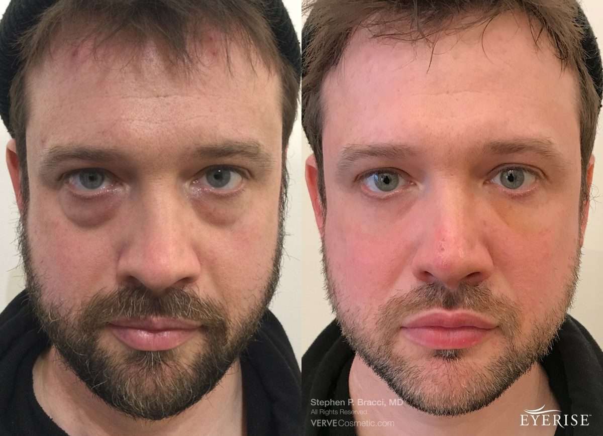 EyeRise | Eye Bag Surgery Alternative | Photos, Pricing