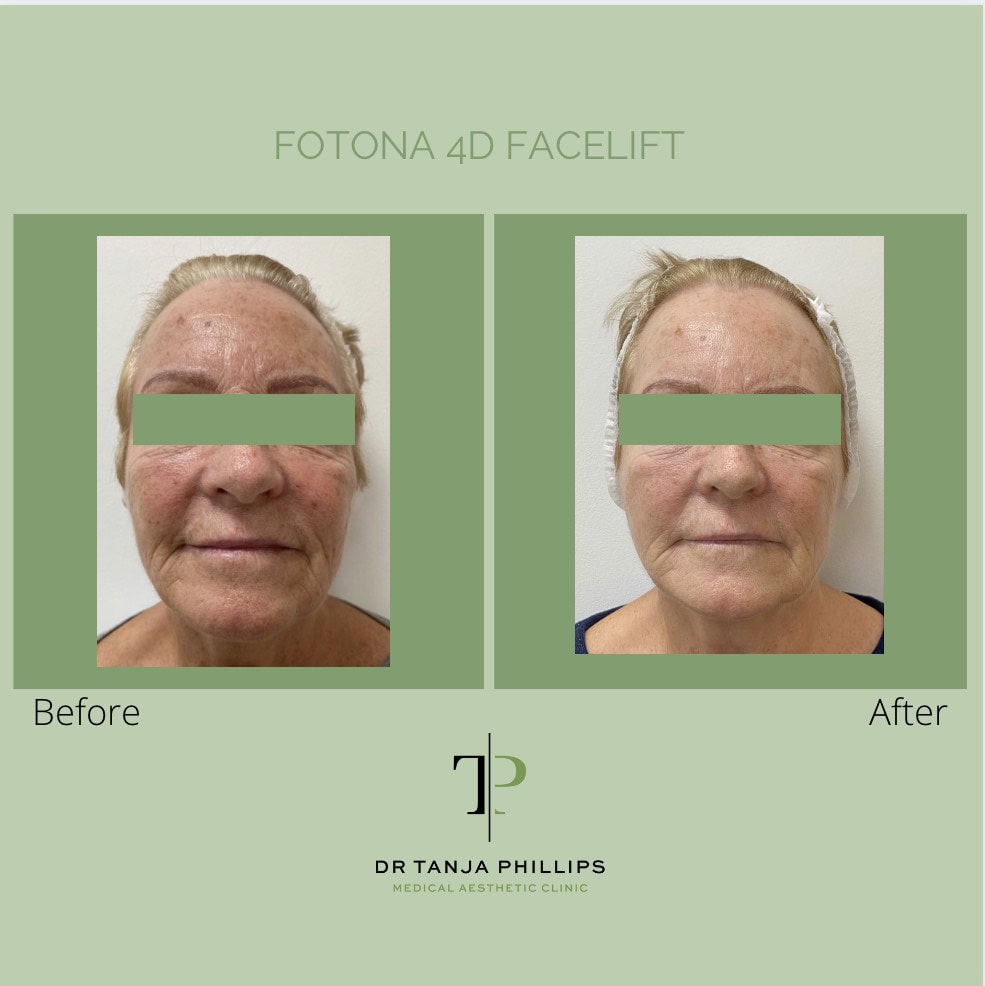 An in-depth look: Fotona 4D Facelift - Dr Tanja Phillips Clinic
