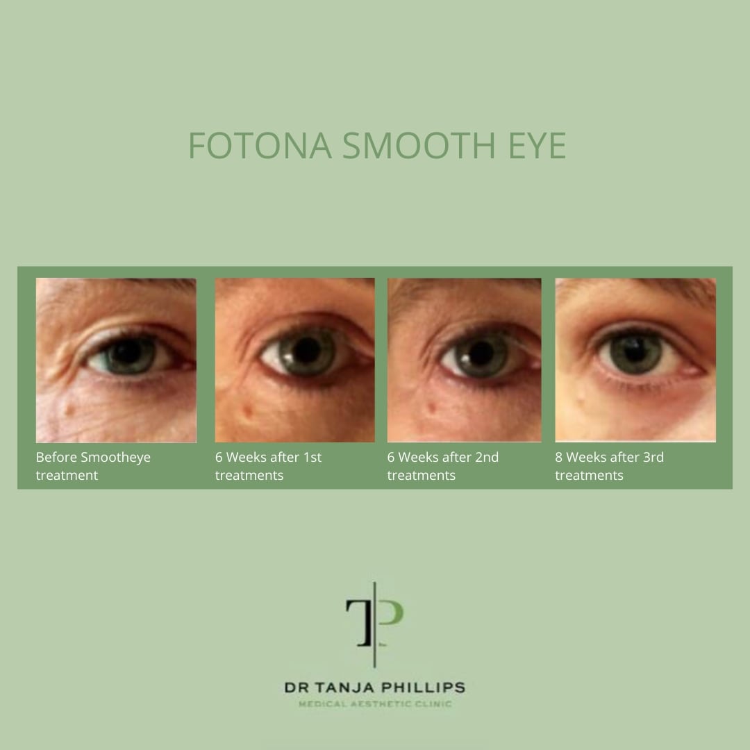 Skin Laser Results - Leading Fotona Laser Specialist Dr Tanja