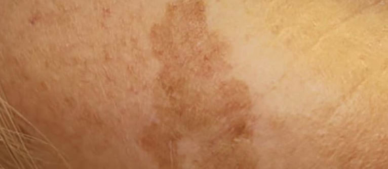 Understanding Sun Spots - Dr Tanja Phillips Clinic